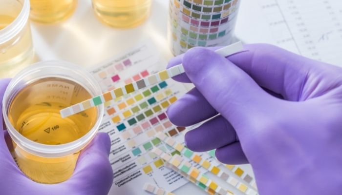 Urinalysis Types Meaning Preparation Of Urine Testing Livlong